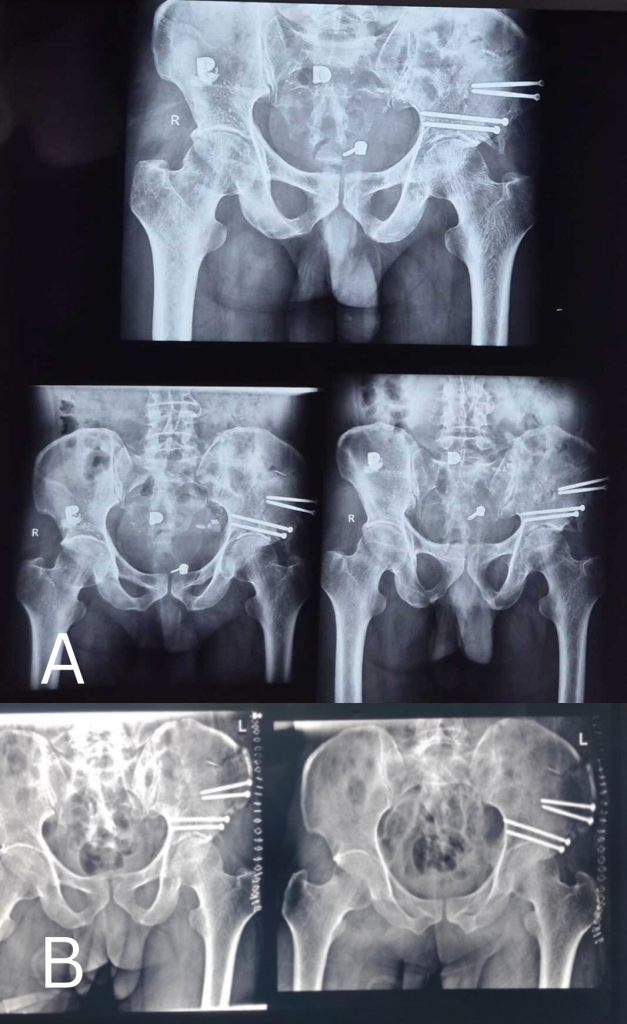 Superior Acetabular Fracture: A Rare Variant Involving Both Anterior ...