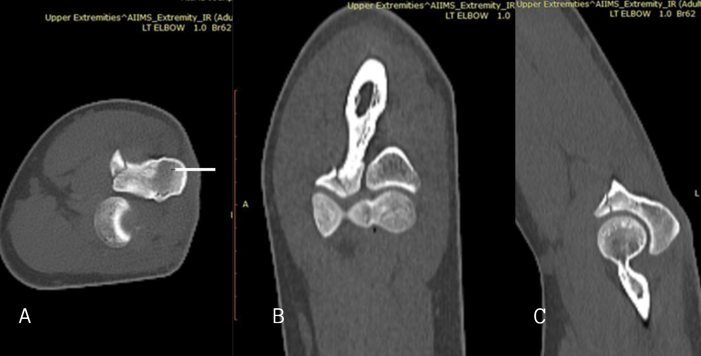 Bilateral Traumatic Scaphoid Fracture Managed Surgically with Headless ...