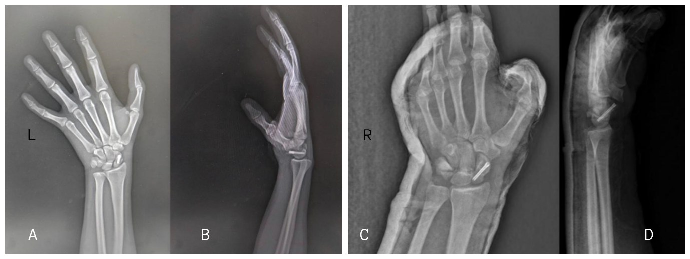 Bilateral Traumatic Scaphoid Fracture Managed Surgically with Headless ...