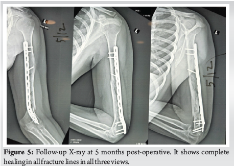Minimally Invasive Posterior Plating for Comminuted Middle to Distal ...