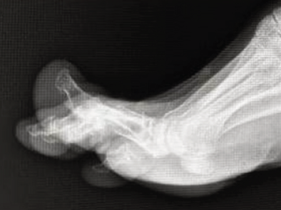 Current Issue | Journal of Orthopaedic Case Reports