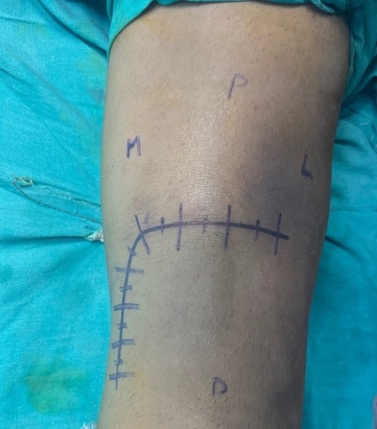 Posterior Approach for Single-stage Fixation of Medial Hoffa with ...