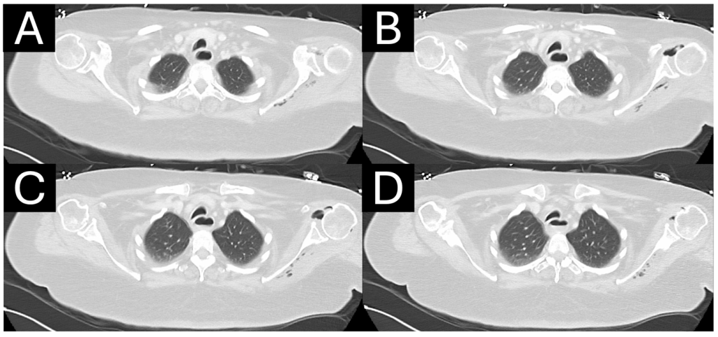 Exclusion of Necrotizing Soft-tissue Infection in a Patient with ...