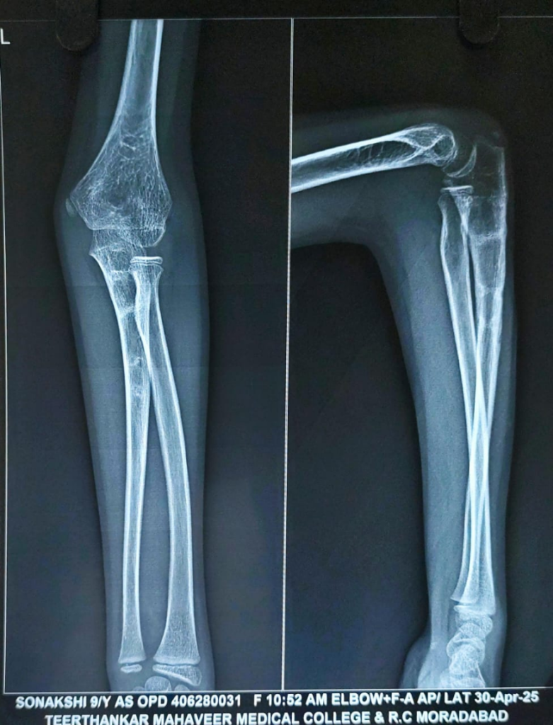 Neglected Monteggia Fracture-Dislocation in an 8-Year-Old Child with ...