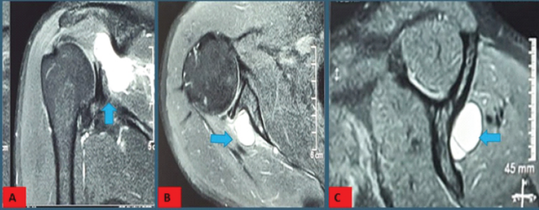 Arthroscopic Spinoglenoid Cyst Decompression and Labral Repair -Case ...