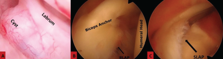 Arthroscopic Spinoglenoid Cyst Decompression and Labral Repair -Case ...