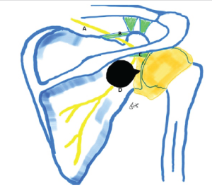 Arthroscopic Spinoglenoid Cyst Decompression and Labral Repair -Case ...