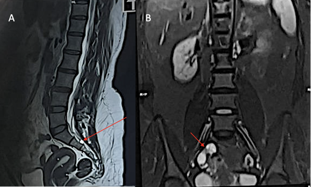 Hitting the Right Nerve: A Rare Case of Vulvodynia from Sacral Tarlov ...