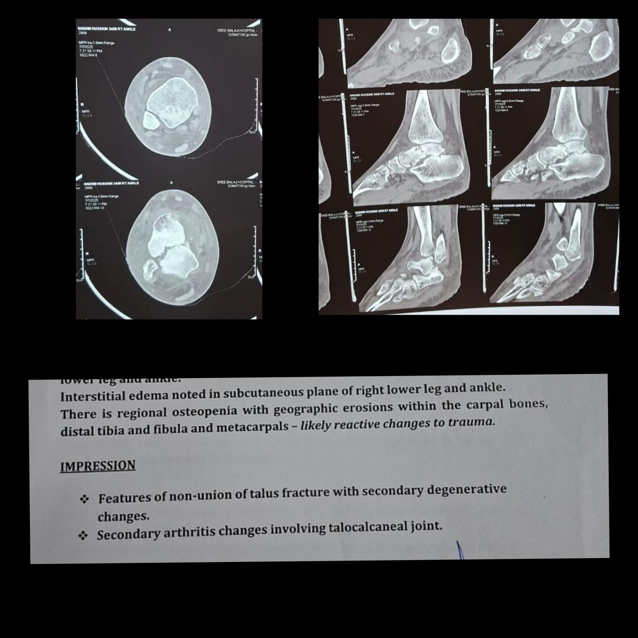 Non-union of Talus Fracture in a 34-Year-Old Male Managed with Open ...