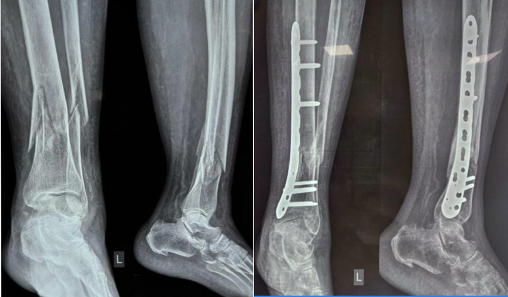 Clinical and Functional Outcome of Distal Tibial Fractures Treated with ...