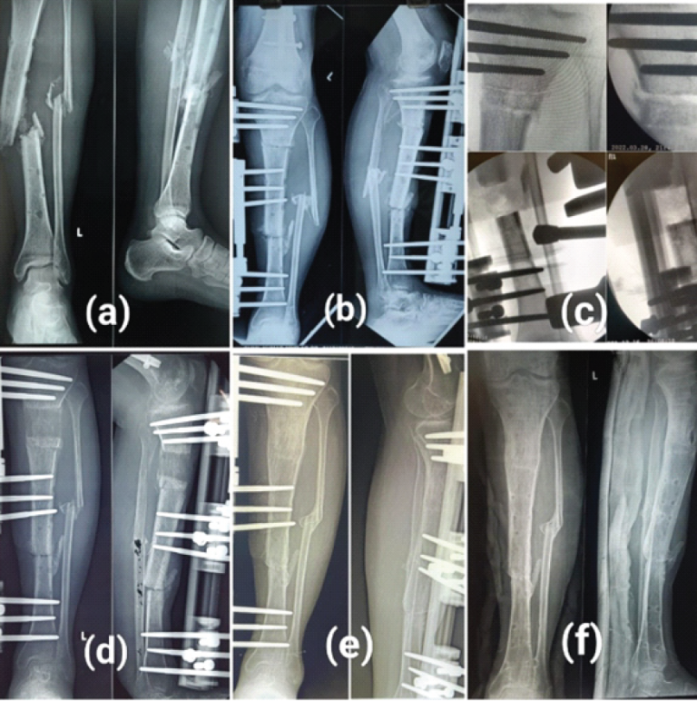 Functional and Radiological Outcome of Ilizarov Ring Fixator versus ...