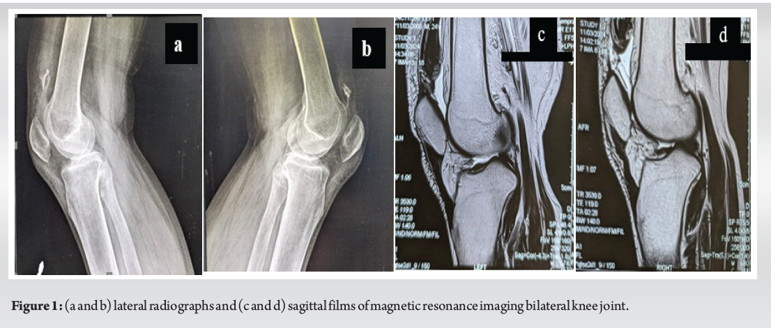 Bilateral Traumatic Rupture of the Quadriceps Tendon – A Case Report ...