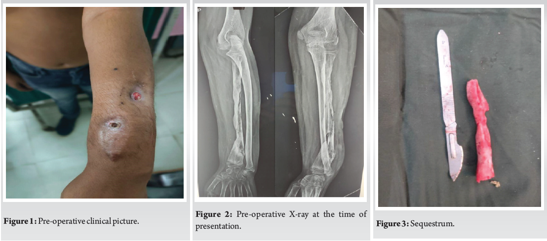 Creation of Single-Bone Forearm in Case of Diffuse Chronic ...