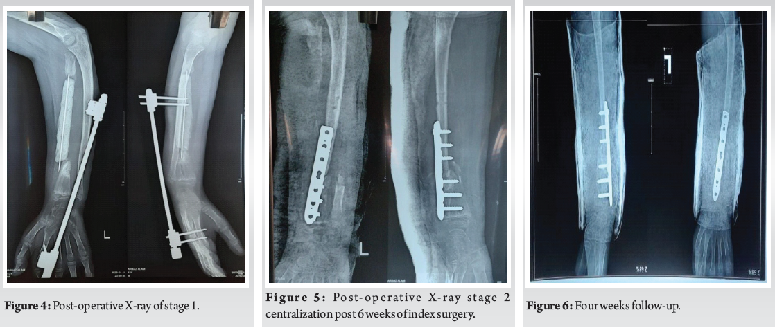 Creation of Single-Bone Forearm in Case of Diffuse Chronic ...