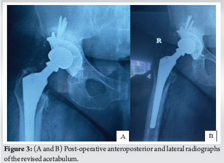 Failure of Metal-on-Metal Total Hip Arthroplasty: The First Reported ...