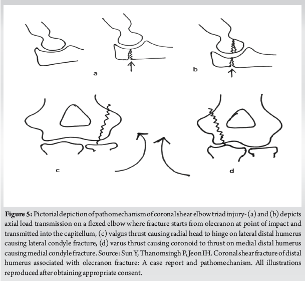 Elbow Coronal Shear Injury Presenting as a Rare Fracture Triad ...