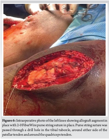 Simultaneous Bilateral Patellar Tendon Ruptures Treated with Primary ...