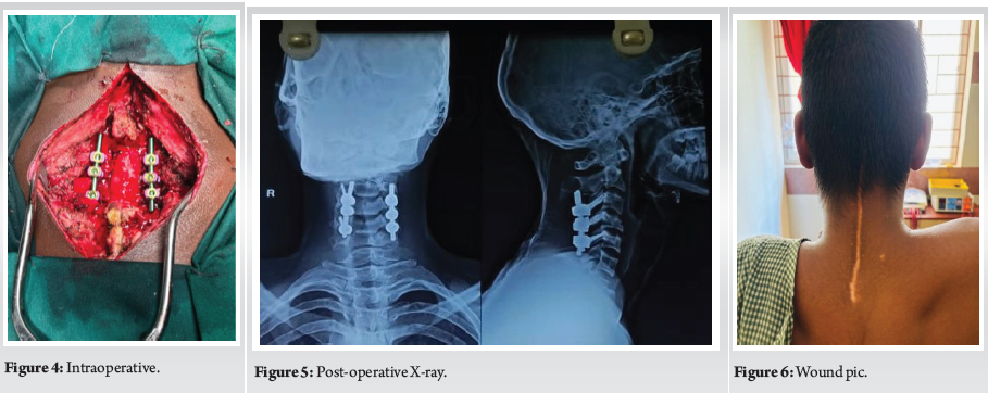 Case Report – Surgical Management and Neurological Recovery in an 18 ...