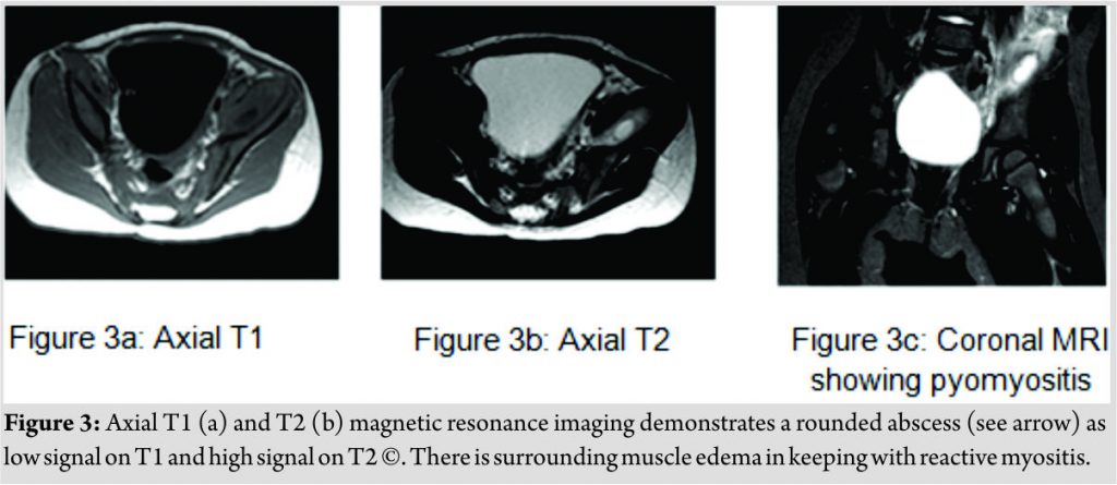 The Limping Child, a Rare Differential: Pyomyositis of the Iliacus ...