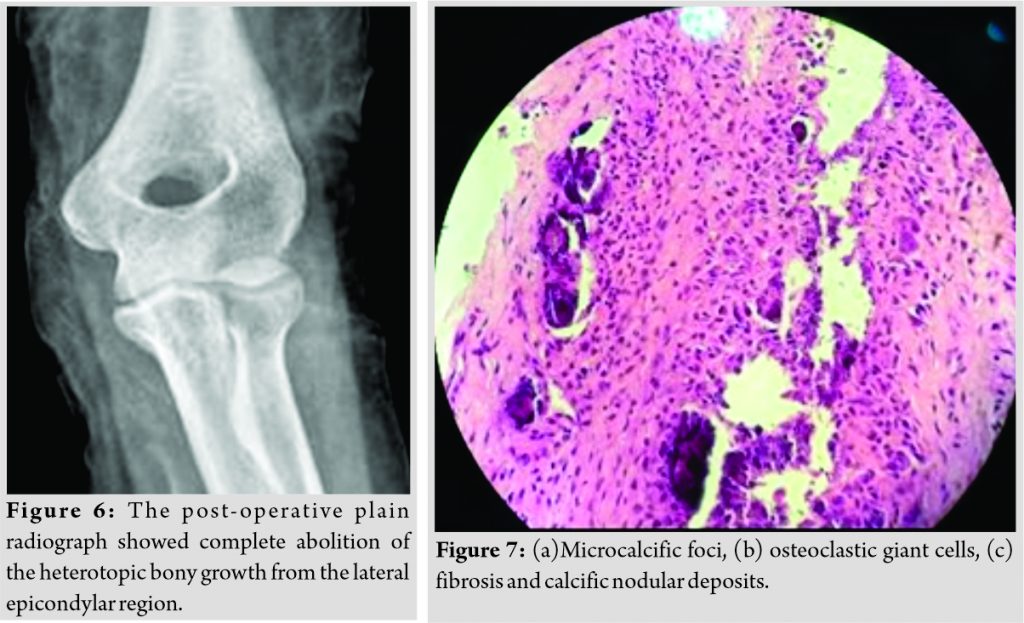 Calcific Tendonitis of the Elbow in an Adult – A Case Report and Review ...