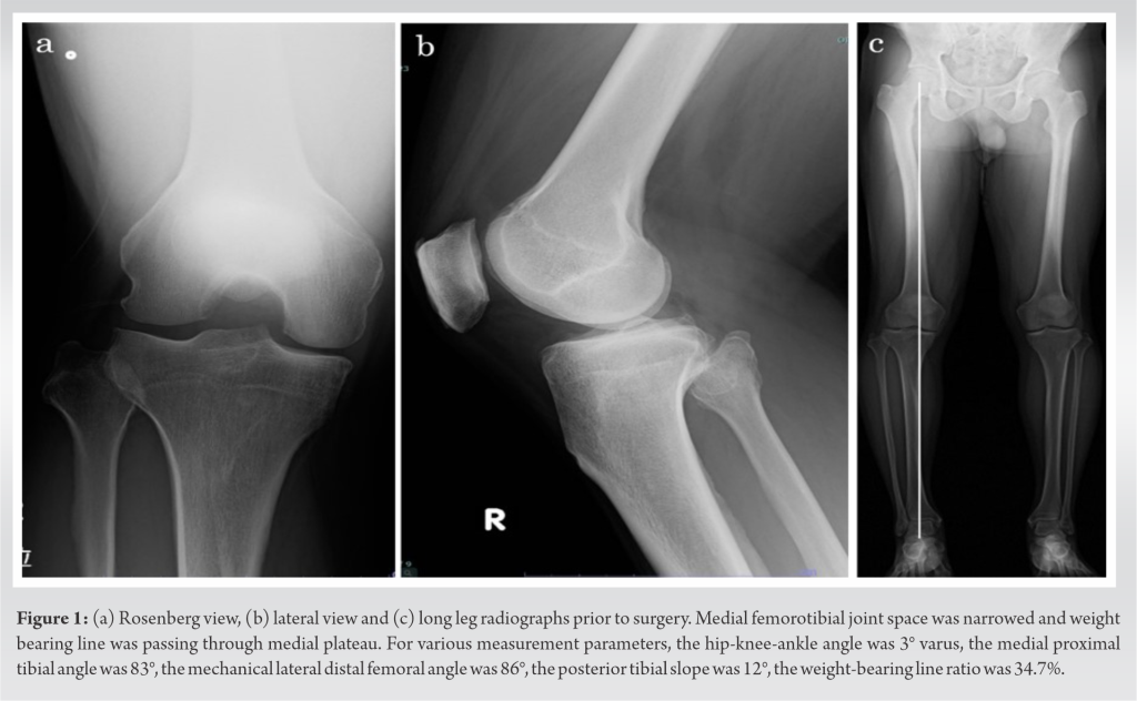 Posterior Aspect Fracture of Tibia after Open Wedge Distal Tuberosity ...