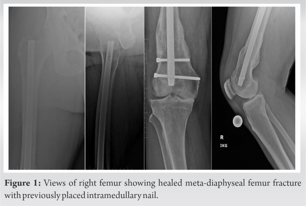 Episiotomy-assisted Incarcerated Femoral Nail Removal: Technical Note ...