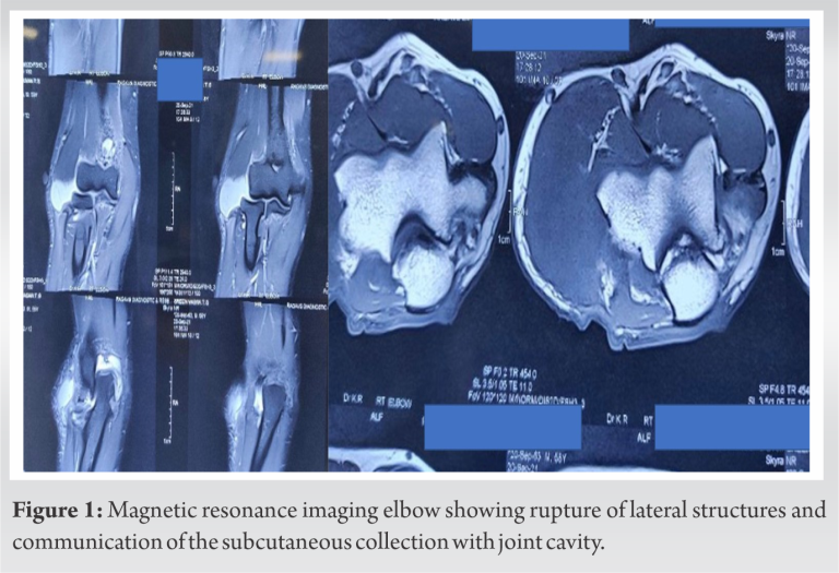Complete Rupture of Common Extensor Origin of Elbow: A Rare Case Report ...