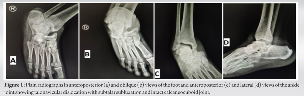 Medial Swivel Dislocation of the Talonavicular Joint Due to High-Energy ...