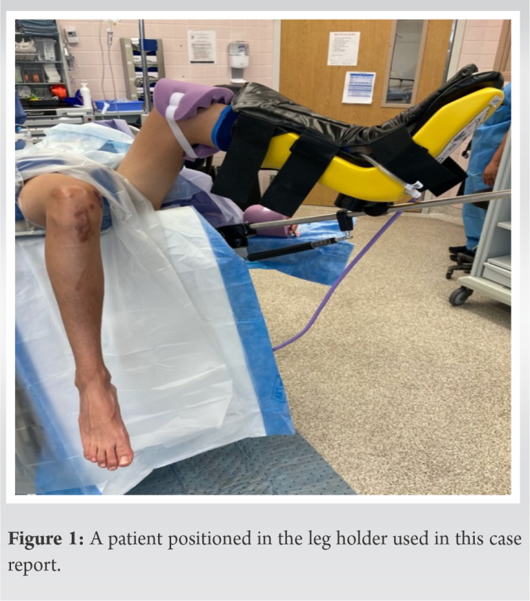 Well-Leg Compartment Syndrome Due to Hemilithotomy Positioning after ...