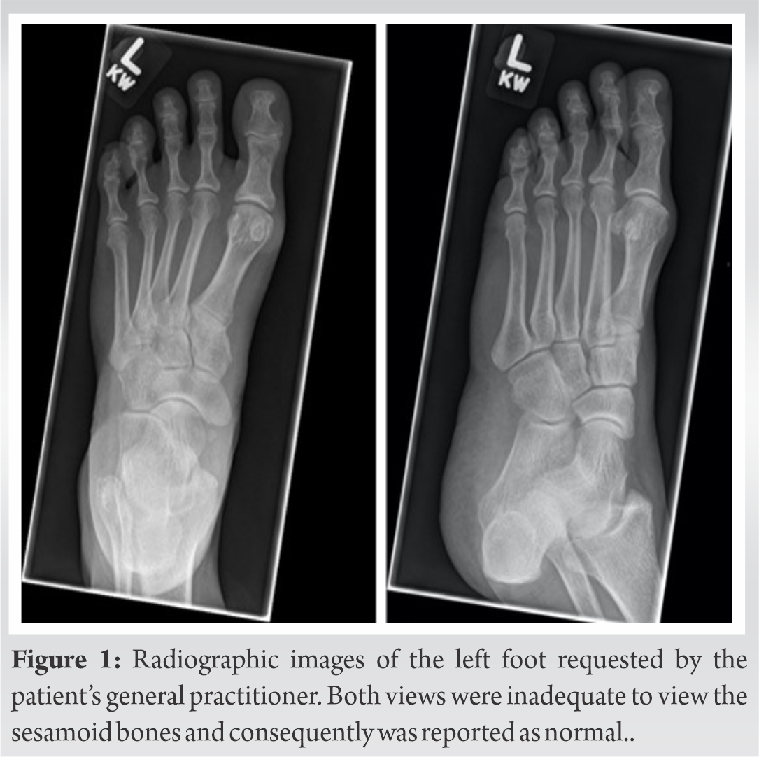 A Rare Case of Exostosis of the Medial Sesamoid Bone | Journal of ...