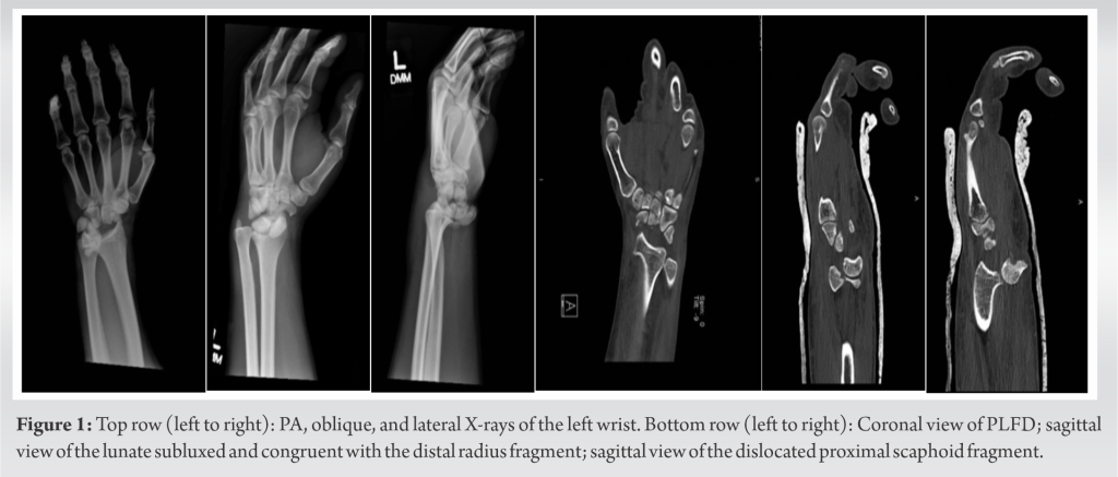 Transscaphoid Transcapitate Perilunate Fracture-dislocation with ...