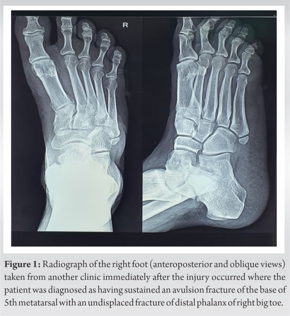 Red Herring in Orthopedics: A Case Report on Painful Os Vesalianum ...