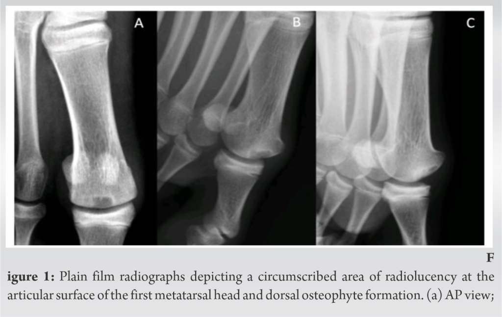 Case Report of an Osteochondral Lesion of the First Metatarsal Head in ...