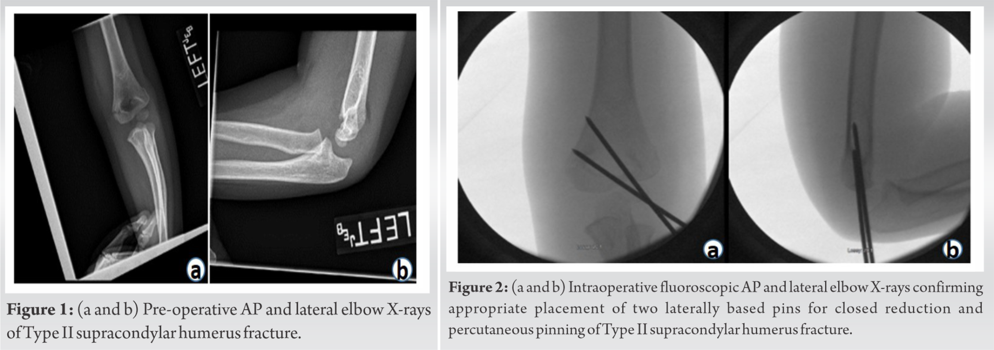 Fishtail Deformity after Type 2 Supracondylar Humerus Fracture with ...