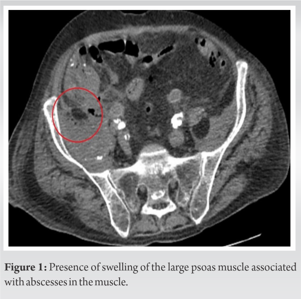 Prosthetic Hip Joint Infection of Digestive Origin, Diagnosis of a Rare ...