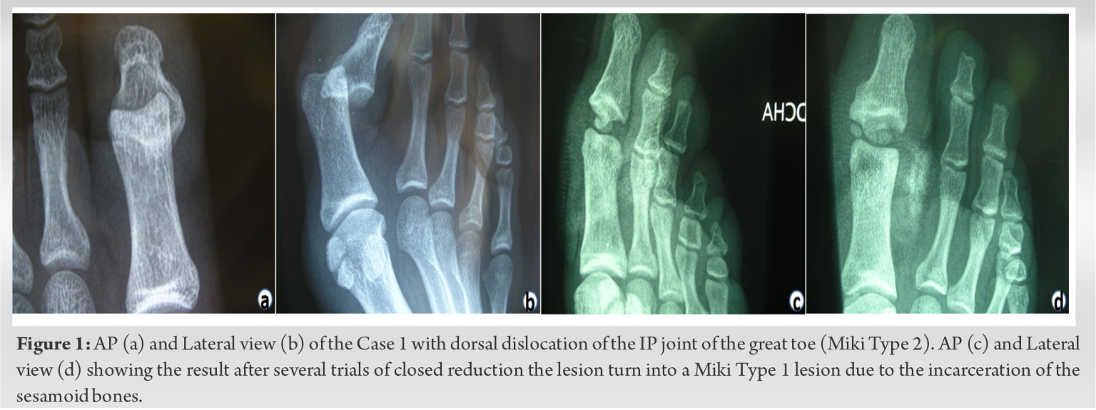 Irreducible Dislocation of the Great Toe Interphalangeal Joint, Dorsal ...