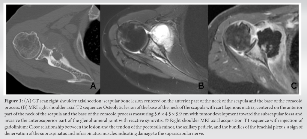 Total Scapular Prosthesis, an Option for the Treatment of Scapular ...