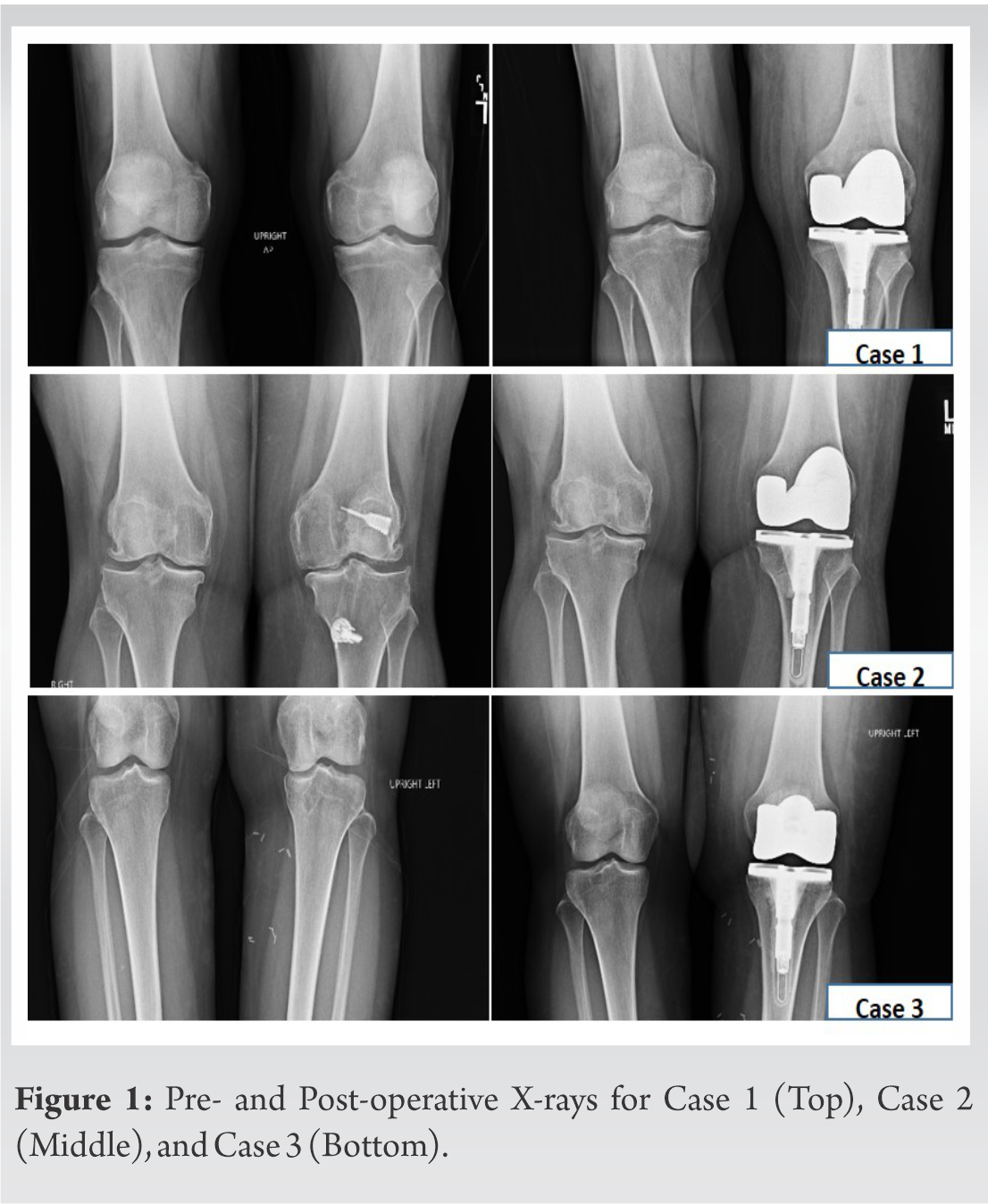 Manipulation under Anesthesia Following TKA with Persona IQ: A Case ...