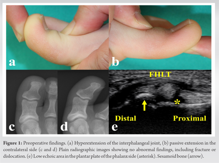 Plantar Plate Repair using Suture Anchors for Chronic Plantar Plate ...