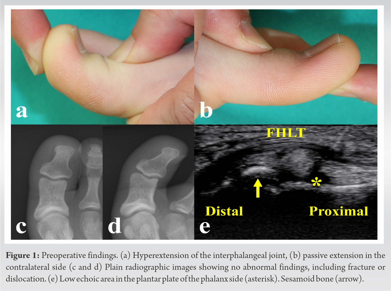 Plantar Plate Repair using Suture Anchors for Chronic Plantar Plate ...
