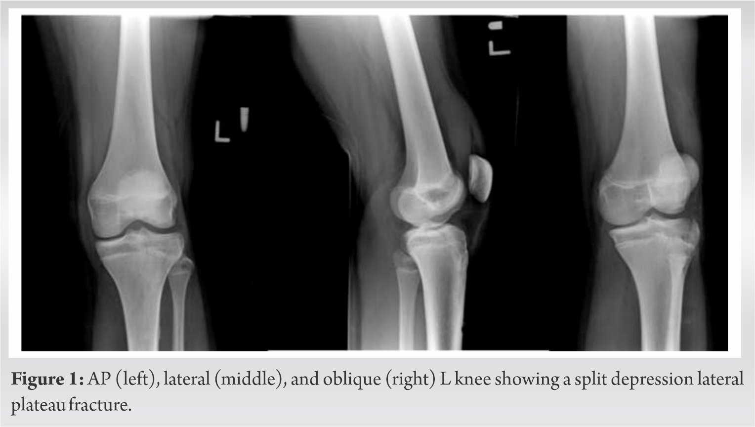 Combined Lateral Plateau and PCL Injury in a Pediatric Patient: A Case ...