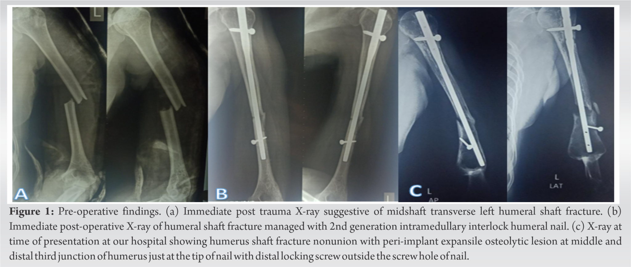 Windshield Wiper Effect in Human Bone-Peri-Implant Benign Diaphyseal ...