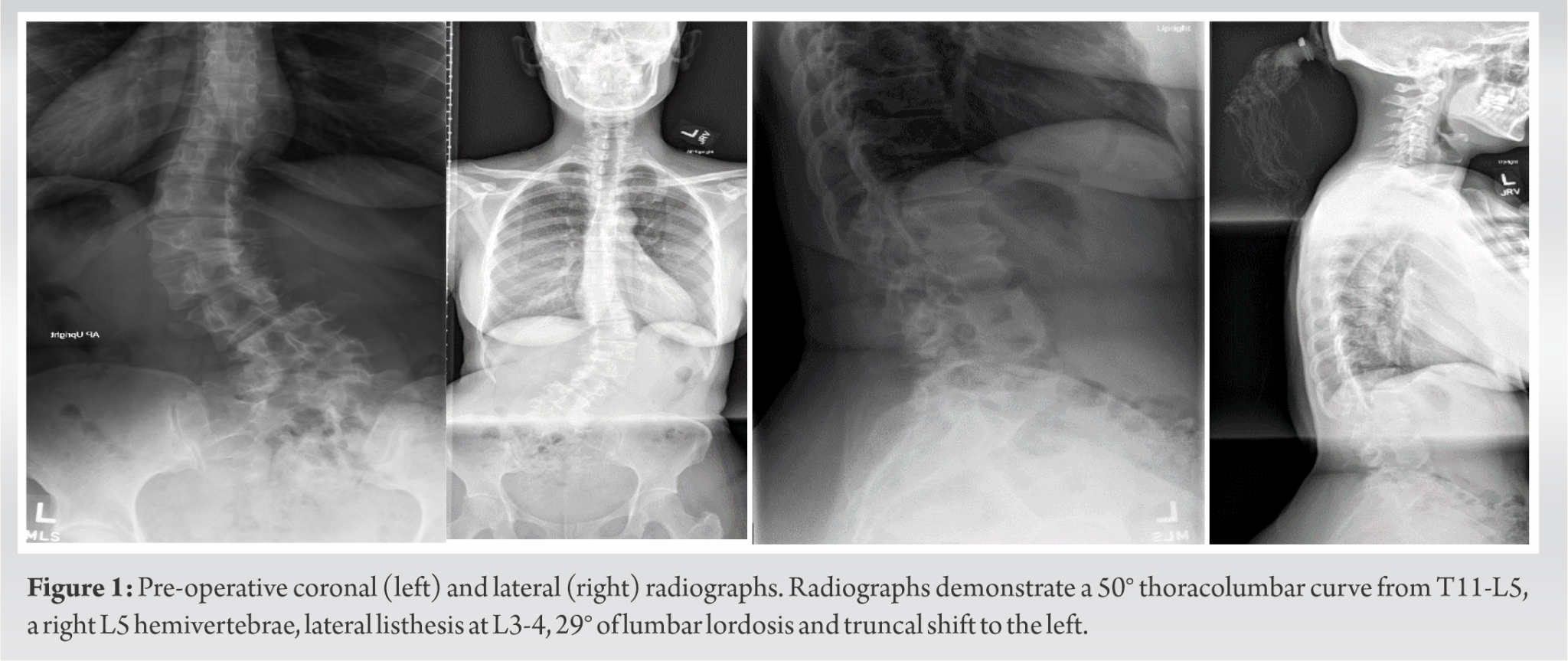Multilevel Customized 3D-Printed Titanium Alloy Interbody Cages used to ...