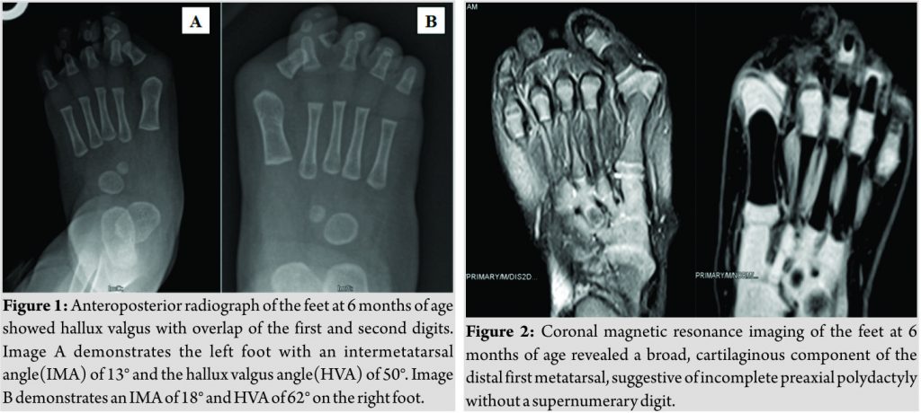 A Case Report of Congenital Hallux Valgus from an Incomplete Preaxial ...