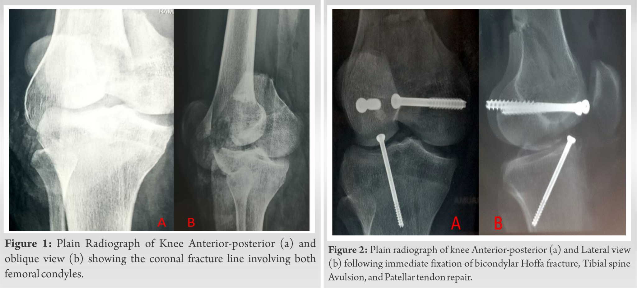 Open Non-conjoint Bicondylar Hoffa Fracture with Ipsilateral Tibial ...