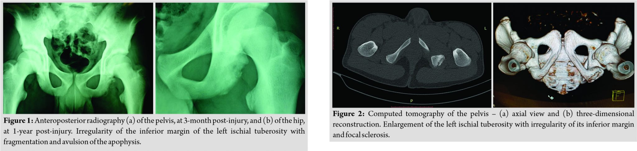Apophysitis of the Ischial Tuberosity: A Case Report | Journal of ...