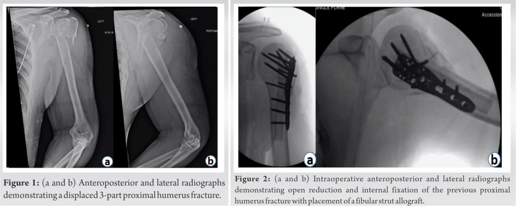 Peri-implant Proximal Humerus Fracture Stabilized with Stacked Plating: A Case Report | Journal ...