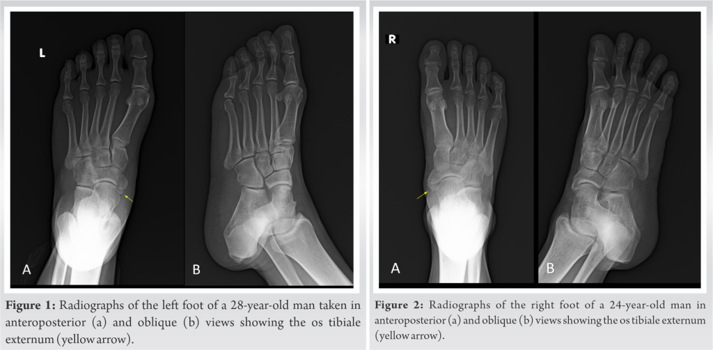 Beyond the obvious: Exploring Os Tibiale Externum and Os Peroneum in ...