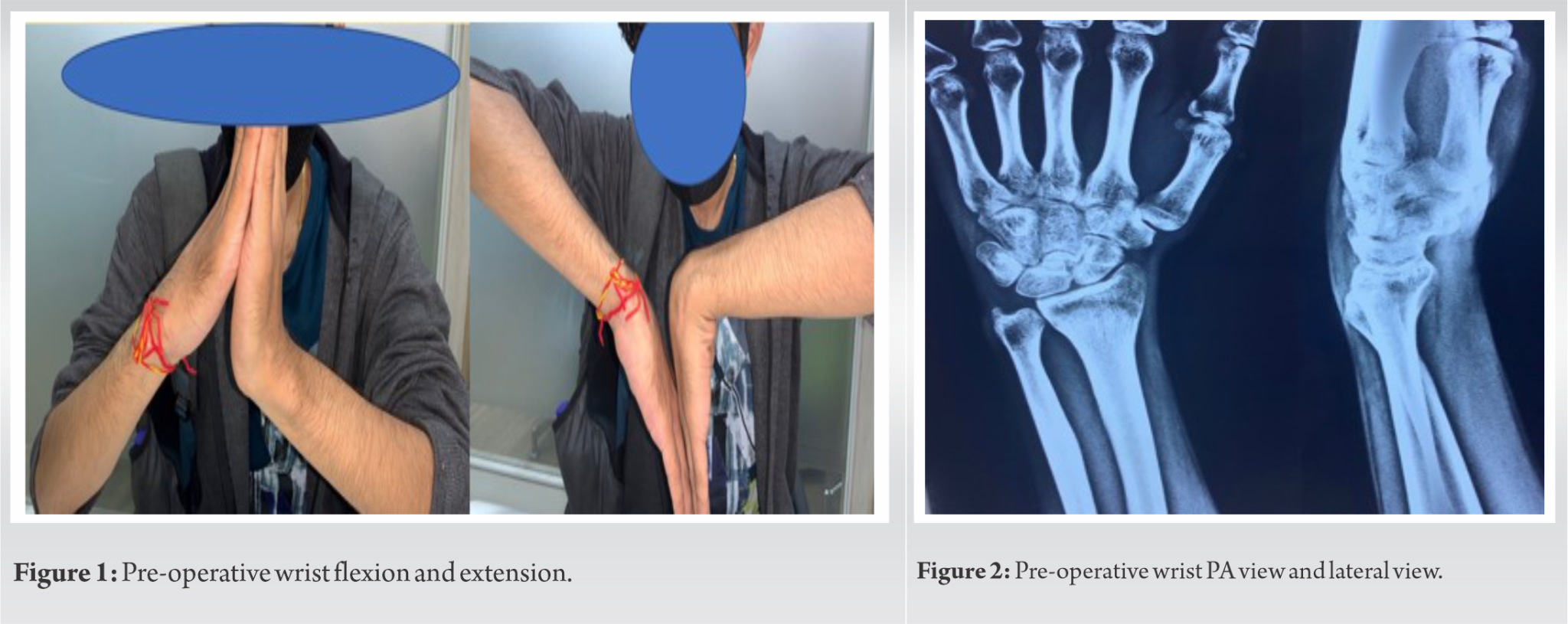 Chronic Neglected Scapho-capitate Syndrome: A Rare Case Report with ...
