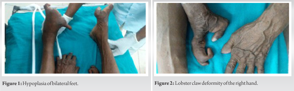 A Rare Case Report of Split Hand and Foot Malformation | Journal of ...